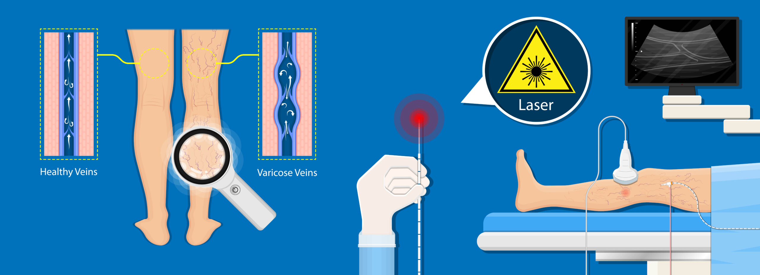 Endoluminal Laser Ablation | Venia MD in CDA