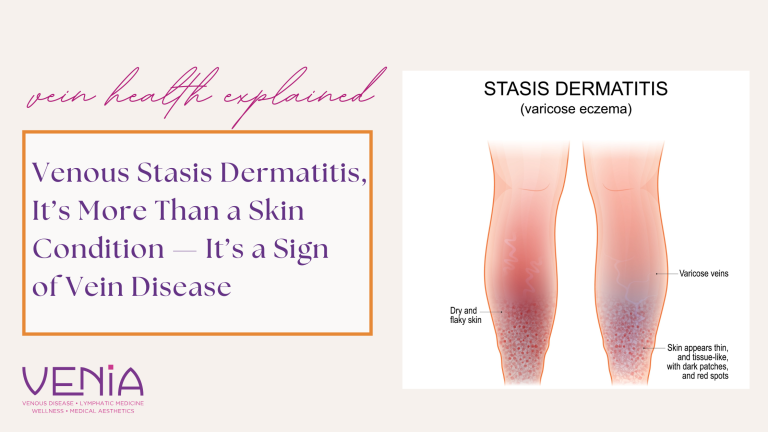 Venous Stasis Dermatitis Care | Venia MD in CDA